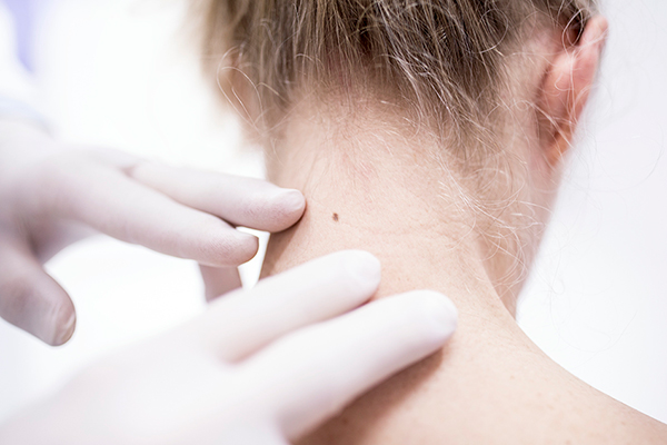 An unexpected resource for important skin checks | Parkview Health