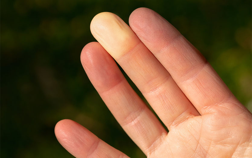 Understanding Raynaud’s phenomenon | Parkview Health